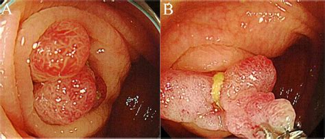 The Colonoscopic Appearance Of The Appendix A Bifoliate Polyp Located
