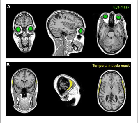 Figure 3 From Whole Brain Myelin Mapping Using T1 And T2 Weighted Mr