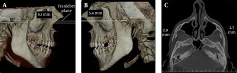 Three Cases Of Elongated Mandibular Coronoid Process With Different