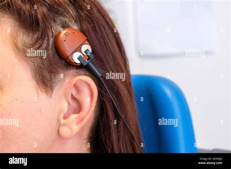 The Cochlear Implant Electrodes At Joshua Tyler Blog