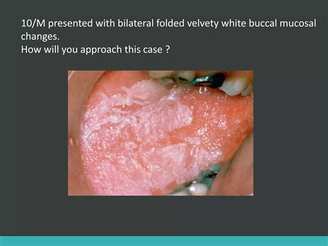 White Lesions Of Oral Cavity Pptx White Lesions Of Oral Cavity Pptx