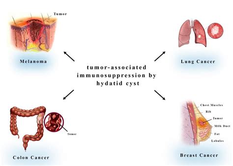 Hydatid Cyst Associated Immunosuppression In Cancer This Figure