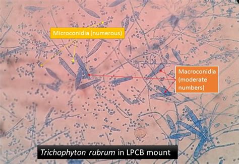 Trichophyton Rubrum In Lpcb Mount And Its Preparation In Details