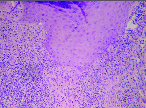 Close Up Histologic View Showing The Important Pathologic Features