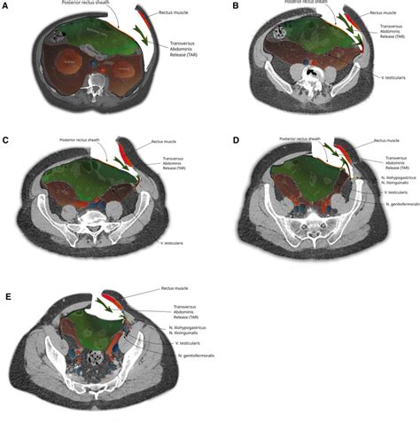 The Preperitoneal Space In Hernia Repair Pmc