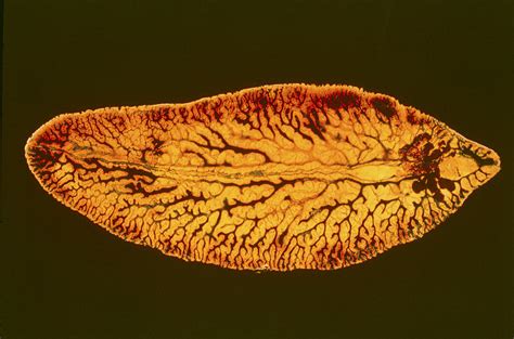 Liver Fluke Diseases Parasites In Liver Disease Easy Sites