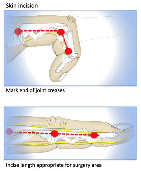 Interphalangeal Finger Joint Dislocation In Fencing Assic Education