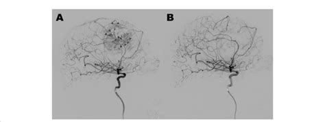 Case 4 Lateral View Of Pre Embolization A And Post Embolization B