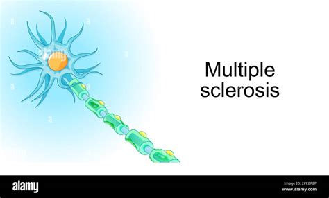 Multiple Sclerosis Demyelinating Disease Autoimmune Disease Vector
