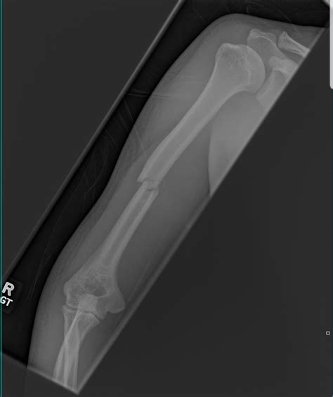 I Am At Week 7th Aftwr Humerus Shaft Fracture Splint Was Off After 3