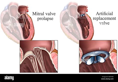 Mitral Valve Prolapse Images Mitral Valve Prolapse Causes Symptoms