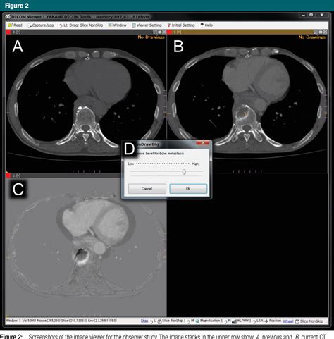 Figure 2 From Temporal Subtraction Of Serial Ct Images With Large Deformation Diffeomorphic