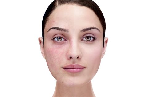 tunelização Archives Dermatologista Porto Alegre Dra Juliana Fonte