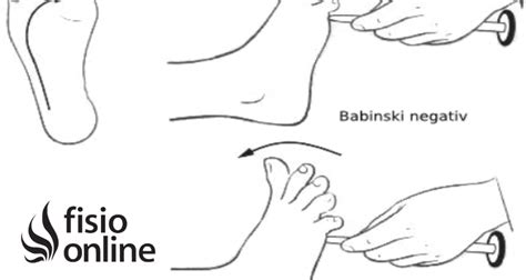 Babinski Qué es características cómo se valora tiempo de aparición