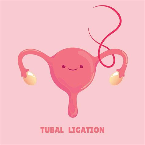 Tubal Ligation Medical Procedure Vector Illustration 29325557 Vector
