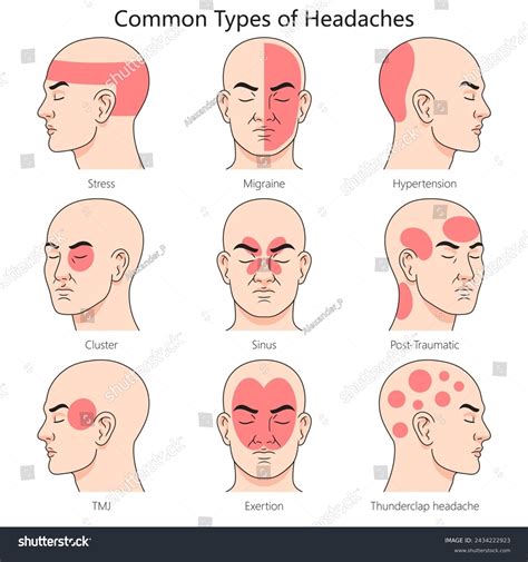Human Headache Type Structure Diagram Hand Stock Illustration