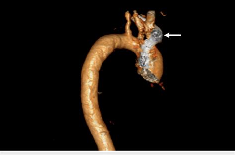 Preoperative Ct Aortogram 3d Showing A Dilated Aorta With A