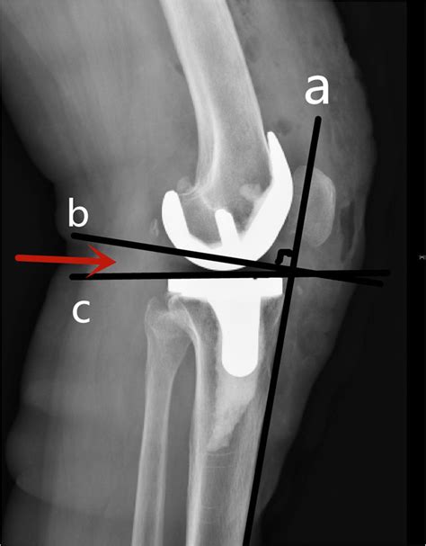 Schematic Diagram Of A Posterior Tibial Slope A The Tibia Anterior