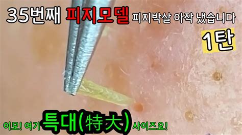 피지 직접 뽑아드렸습니다 피지제거 블랙헤드제거 피지뽑기 세종특별자치시의 자랑이 되고픈 열혈 남성 구독자님의 피지를