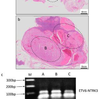 Expression Of ETV6 NTRK3 Fusion Transcript In The Primary Lesion And