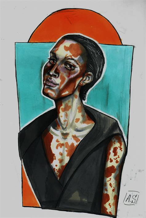 Vitiligo Beauty By Pembrokedraught On Deviantart
