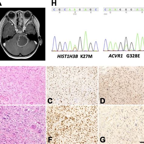 Profile Of The Patient With H3K27M Mutant Diffuse Midline Glioma A Download Scientific