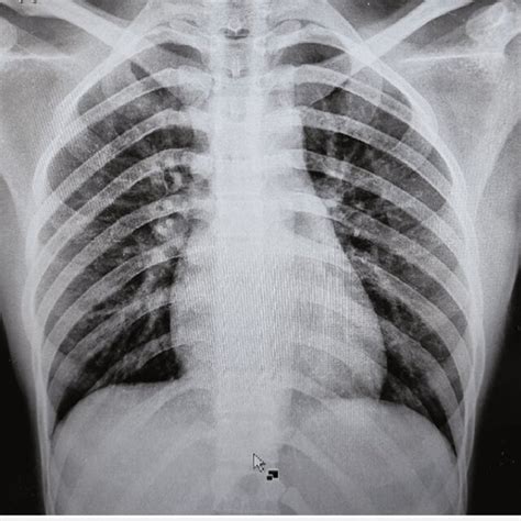 Chest Radiograph Pa View Showing Normal Lung Fields Except For A Few