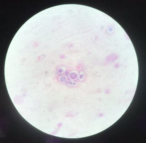 Budding Yeast Cells With Pseudohyphae From Sputum Gram Stain Tes Stock