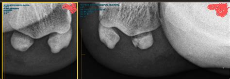 Sesamoid Fracture R Sesamoid