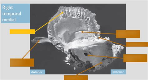Temporal Bone Medial Diagram Quizlet