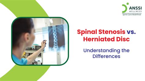 Spinal Stenosis Vs Herniated Disc Understanding The Differences Anssi Wellness