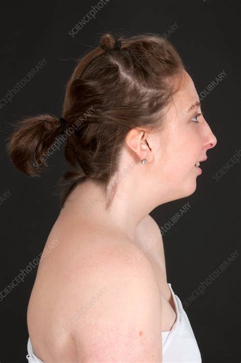 Turner Syndrome