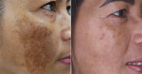 Best Melasma Treatments In Brisbane Melasma Removal Cutis Clinic