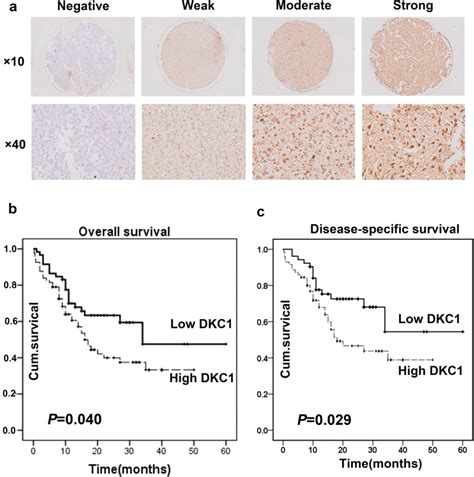 Expression Of Dkc1 In Human Glioma Pathological Sections A