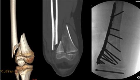 With Pediatric Distal Metaphyseal Femur Fractures I Find The Proximal