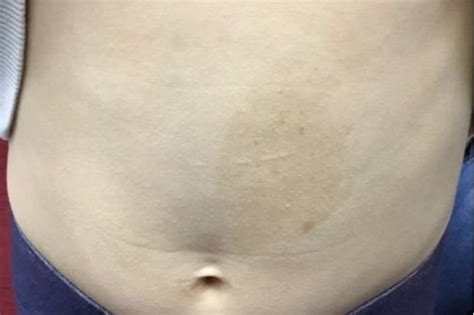 Derm Dx Hyperpigmented Macule On The Abdomen Dermatology Advisor