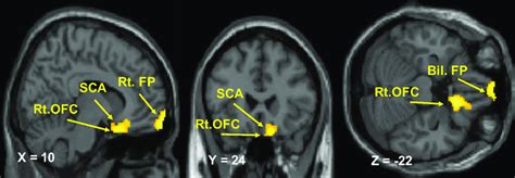 Resting State Functional Connectivity Of The Right Anterior Insular