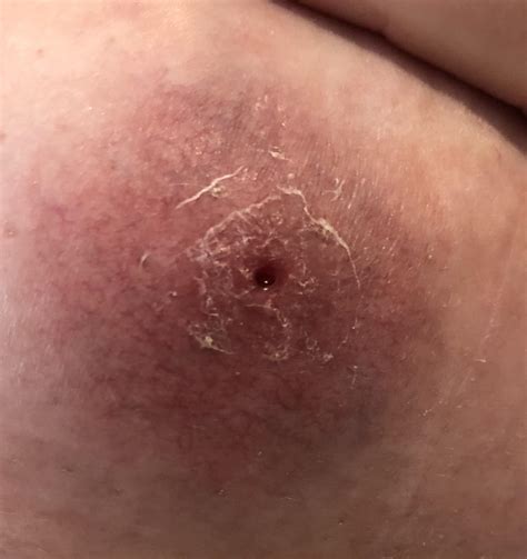 Im Assuming Spider Bite Due To The Suddenness Of This Appearing But