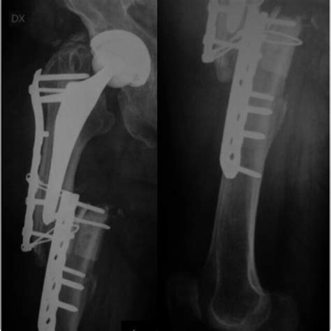 Hardware Failure 4 Days After The Surgery Download Scientific Diagram