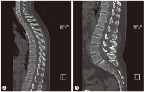 Sagittal View Of Computed Tomography Of A Thoracic Sp Open I