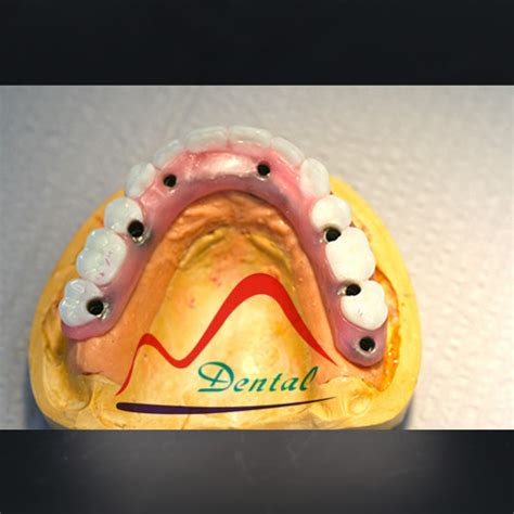 Dental Implant Hybrid Dentureid10437685 Buy China Aesthetic Dental