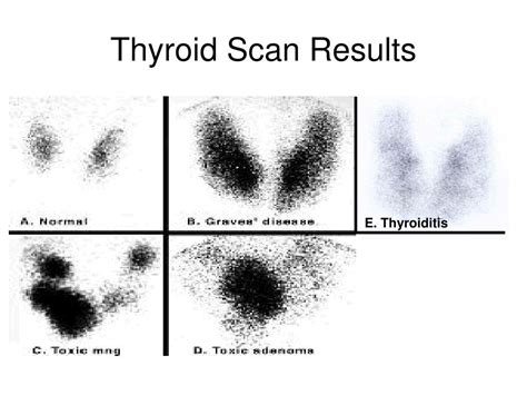 Ppt Everything You Ever Wanted To Know About The Thyroid But Were Afraid To Ask Powerpoint