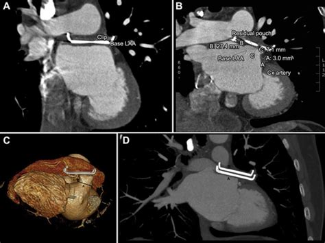 Atricure Left Atrial Appendage Clip Efqf