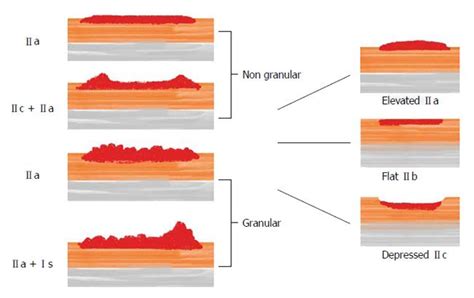 Non Polypoid Colorectal Neoplasms Classification Therapy And Follow Up