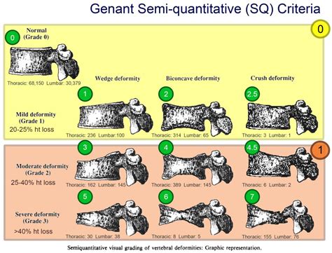 Deep Learning Classification Of Spinal Osteoporotic Compression
