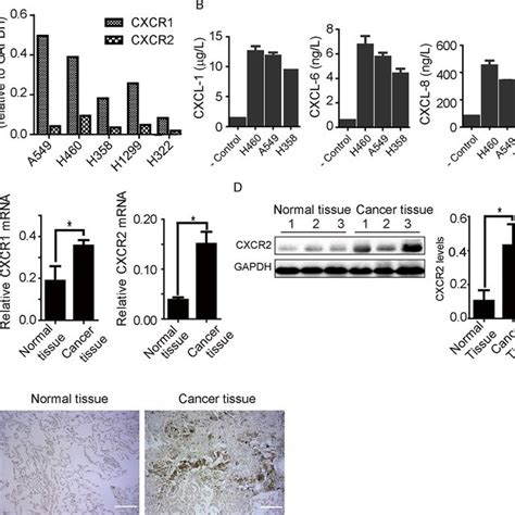 Expression Of Cxcr1 And Cxcr2 Receptors In Human Lung Cancer Tissue And