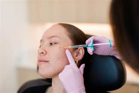 Deep Smile Lines Fix Them Without Looking Overdone