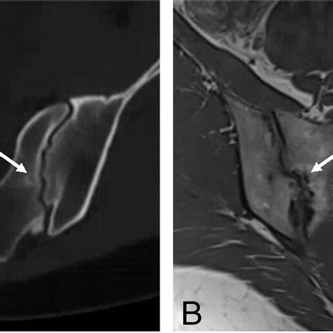 Mri Imaging Of The Sacroiliac Joints Of A 30 Year Old Female Patient