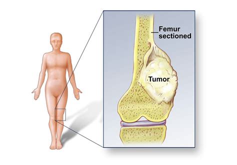Amputation For Bone Sarcoma Associated With Socioeconomic Disparities
