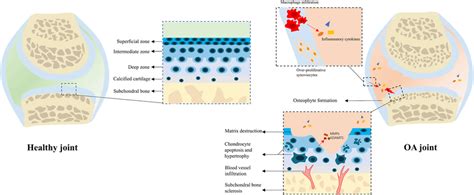 Physiological And Pathological Structure Of The Joint In A Healthy